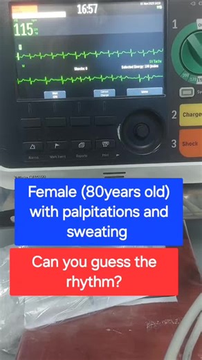 Understanding EKG Rhythm Interpretation for Nurses