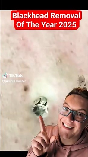 BLACKHEAD REMOVAL OF THE YEAR 2025 #shorts