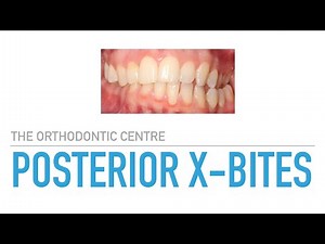 Posterior Cross-Bite Correction at The Orthodontic Centre