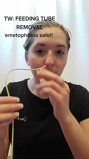 See ya Tuesday noodle :) (IB @sarakruegerr) #feedingtuberemoval #njtube #feedingtube #fyp #chronicallyill #pots #posturalorthostatictachycardiasyndrome #chronicillness #chronicpain #foryoupage