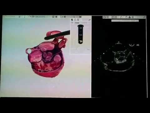 How to image the pulmonary veins by TEE?