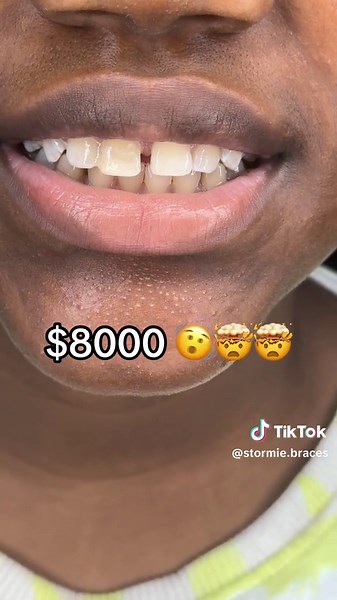 Affordable Braces Installation in Spanish Town, Jamaica