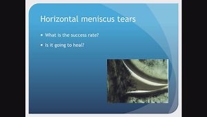 Modern Meniscal Repair Techniques