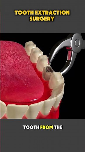 How a Tooth Extraction Is Performed | Step-By-Step Dental Procedure #ToothExtraction #dentalsurgery