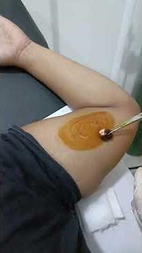 IMPLANON REMOVAL AND INSERTION AT THE SAME TIME/FAMILY PLANNING METHOD/HORMONAL