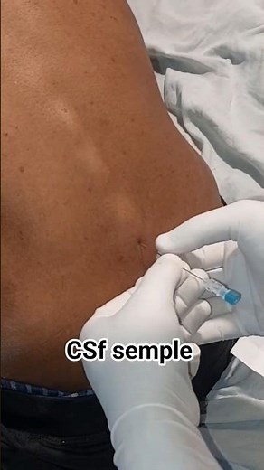 CSF Sample Collection and Culture Test | Full Procedure in Hospital #shorts #viral #trending