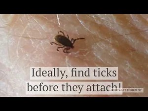 How to Remove a Tick