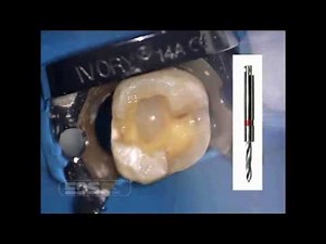 Flexi Post Reconstitution corono radiculaire