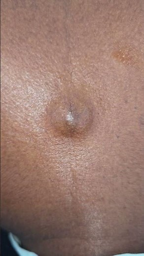 Back Sebaceous cyst
