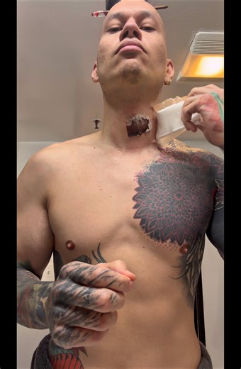 1 week post surgery scar update (ACDF C5-C7)