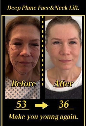 Efectos de la técnica 4D en el rejuvenecimiento facial