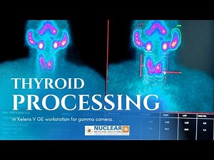 Thyroid Scan Processing Workflow in GE Xeleris Workstation for Gamma Camera