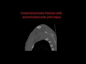 Coracoid process fracture with acromioclavicular joint injury l Ct scan l Shoulder Joint