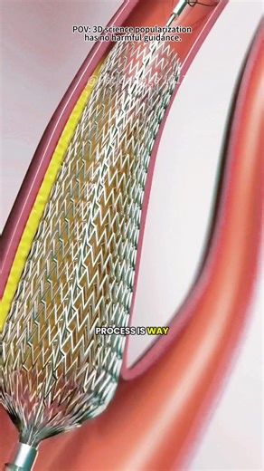How Stents Restore Blood Flow(3D Animation) #stentangioplasty #angioplasty #heartprocedure #cardiology #blockedarteries