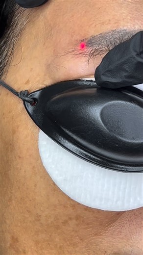 Oritnakash- Microblading artist on Instagram‎: "⁨ ⁨ הסרת איפור קבוע בטכנולוגית לייזר - זמן טיפול -2 דקות בלבד ! לא ניתן לבצע את הטיפול לנשים בהריון , מניקות , בעלות קוצב לב , אפילפסיה , נטילת רואקוטן. - אין לדעת את מספר הטיפולים שתצטרכי , שכן זה תלוי במספר גורמים : 1. סוג הפיגמנט 2. עומק הפיגמנט 3.מספר החידושים שביצעת באזור . 4. מטאבוליזם( חילוף חומרים ) - בין טיפול לטיפול נמתין כחודש וחצי , למטרת אפקטיביות הפירוק . לפרטים נוספים -0525660808. ⁩⁩"‎