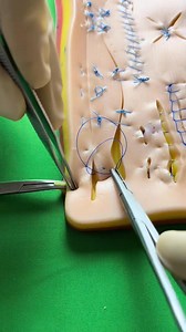 Running percutaneous buried vertical mattress suture | Dermhacks