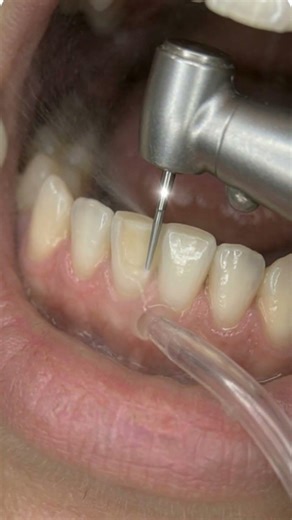 Real Gold Tooth Installation 🦷 Luxury Smile Upgrade | #toothcraft #asmr #dentist #satisfying