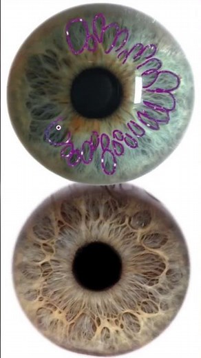 Iridology Flower Iris Type - Flexible, Spontaneous, Changeable. Feeling-Oriented; Flowing with Life.