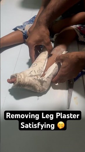 Removing Leg Plaster Satisfying Video | How to remove Leg Cast | Broken Leg Orthopedist 🫢