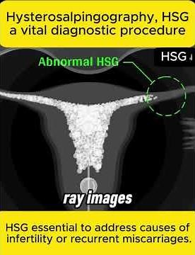 What is an HSG? | A Detailed Look at Hysterosalpingography and Tubal Health