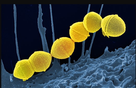 Invasive Group A Strep infections surge across the globe
