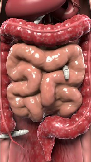 Constipation Animation | Fecal Blockage Inside The Colon
