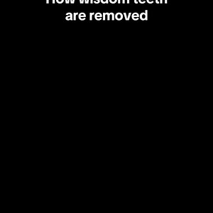 19K views · 272 reactions | Wisdom tooth removal #Dentistry #LearningTips #BitesnBraces #smile #Pakistan #medical #People #dentista #Tooth #Implant #Dental #dentist | Bites & Braces Dental | Facebook