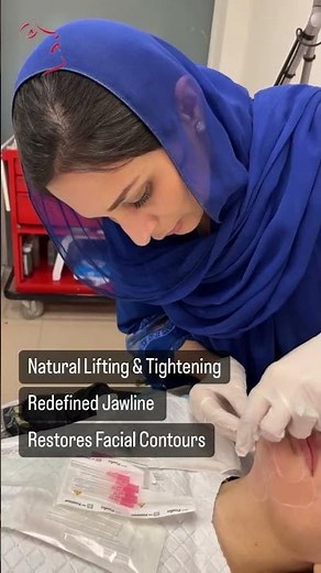 Mono Threads for Double Chin Treatment