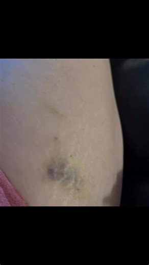 I have to stay elevated and in a compression stocking. There’s super hard to pull on and squeeze my poor toes. I wish they had red 😂 that would’ve been so fun on Halloween. But man, all the bruises and cuts & irritation are finally starting to clear up. My neck is sore, but healing ❤️‍🩹 #release #health #slowmotion #compression #BloodClotAwareness | Magically Inclined LLC