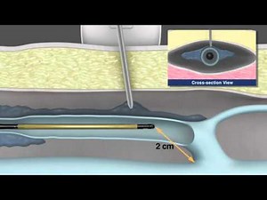 Venefit Procedure Animation - Vein Nevada in Reno, Carson City and Sparks