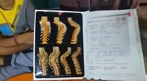 Swayam needs your help to stand on his feet This is to certify that, patient Master Ghadigaonkar Swayam, aged 9 from Belagavi is a case of D5-D6 hemivertebra (is a type of vertebral anomaly and results from a lack of formation of one half of a vertebral body. It is a common cause of congenital scoliosis)(with congenital kyphosis with neuro deficit. He has been advised surgery for the same in the form of spinal deformity correction with anterior reconstruction with harms cage and D2-D9 posterior 