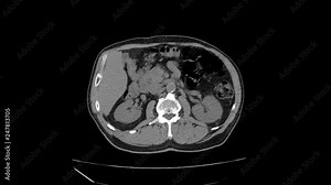 Computed Tomography Abdomen (CT SCAN) Finding isodensity splenic mass. Hemangioma, lymphoma. Both kidneys show no stone and no hydronephrosis. No dilatation of small and large bowel.