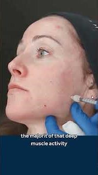 Using the 'Tailing Off' Toxin Injection Technique for Masseter Botox 💎 Live from the GEM© Clinic