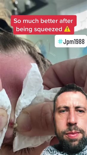 Satisfying Pimple Popping Reactions with Dermatologist - Funny Moments Included