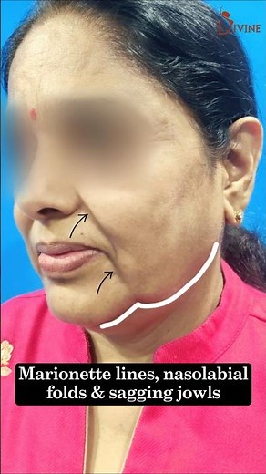 Non-Surgical Facelift Results | Infinite Thread Lift for Youthful, Natural Look