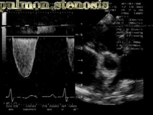 Severe Pulmonary Stenosis: continuous wave doppler recording • Video • MEDtube.net