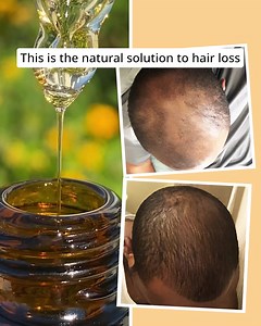 Is your hairline retreating faster than you’d like?  It’s time to fight back with Haitian Black Castor Oil!  Packed with Omega 3, 6, 9 & Vitamin E, this liquid gold nourishes the scalp and supports hair growth.  Don’t let thinning hair hold you back—get started today! | Kreyol Essence | Facebook