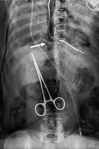 No sponge left behind: tags for surgical equipment - Biomedical Engineering (BME)