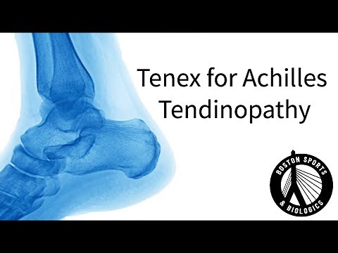 Chronic Achilles Tendon Pain Treatment: Tenex vs. Surgery