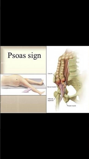 The Psoas sign #surgerystepbystep#Acuteappendicitis