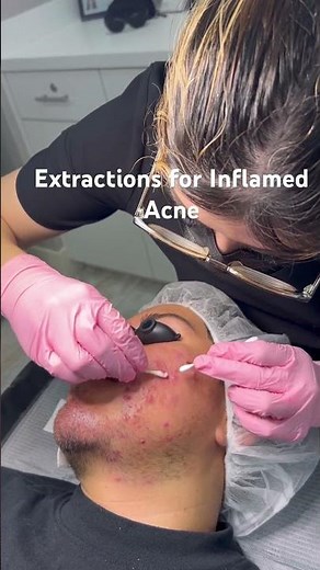 Extraction for inflamed Acne #skinaging #skincare #beauty #brightskin #acne #extractions