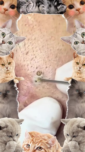 Satisfying Cyst and Blackhead Extractions for Skincare