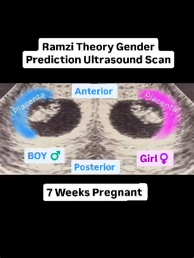7 week Pregnant Ramzi Theory Gender Prediction Ultrasound scan #ultrasound #pregnant🤰 #fyp #medicalstudent #pregnant #unfreezmyaccout