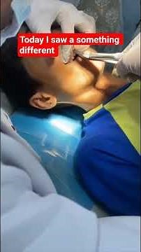 extraction of milk tooth #dentist #dentalprosthesis #dentalprocedure #dentalclinic #dentalartistry