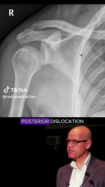 Understanding Posterior Shoulder Dislocation in Radiology