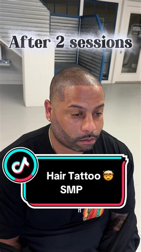 Sometimes hair transplants still lack density, SMP is the perfect solution #hairtransplant #smp #scalpmicropigmentation #hairtattoo #HoustonSMP