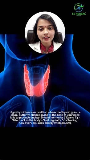 SS Herbal India on Instagram: "Hyperthyroidism: An Accelerated Internal Rhythm. . . Hyperthyroidism is a clinical condition characterized by an overactive thyroid gland that produces and releases an excessive amount of thyroid hormones—primarily thyroxine (1$T_4$) and triiodothyronine (2$T_3$).3 Because the thyroid acts as the body's "master controller" for metabolism, an overabundance of these hormones essentially puts the body’s systems into overdrive, leading to a state of hypermetabolism. Ca