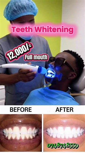 Teeth Whitening by Bleaching: Full Mouth Treatment