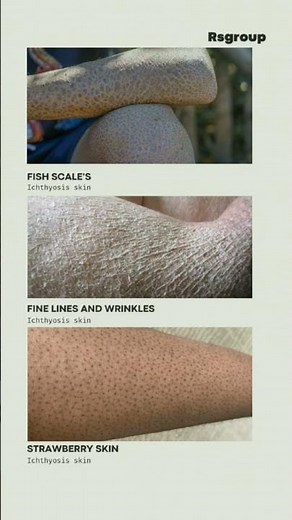 Ichthyosis Treatment: Effective Solutions for Skin Condition - Your Guide to Treating Ichthyosis