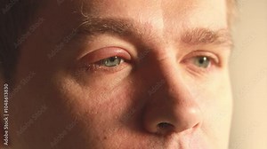 Stye eye, barley eye, chalazion eye, infection on eye on male face. 4k, high-quality video